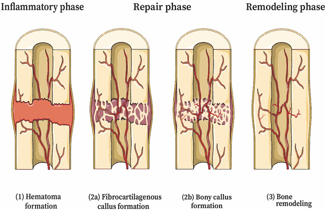 How a Bone Stimulator Benefits You After Spinal Fusion - DAPHCO ...